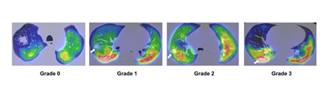 Lung Perfusion Spect Ct Visual Assessment Of 99mtc Maa Distribution Download Scientific Diagram