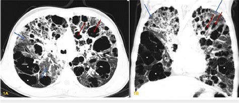 Ct Scans Showed Centrilobular And Paraseptal Emphysema Stars