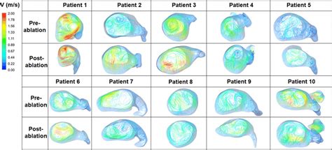 velocity streamlines in a plane above the laa and below the pulmonary