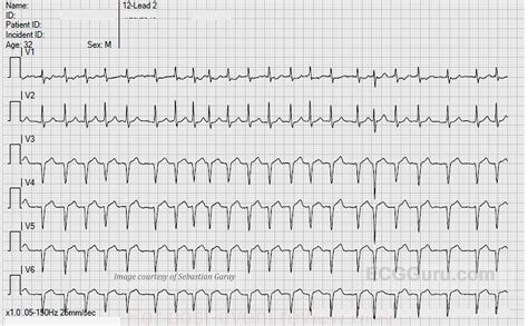 Nstemi Ecg Guru Instructor Resources