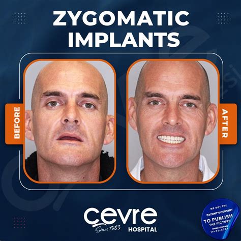 2024 Zygomaticzygoma Implants In Istanbul Turkey Cost And Updates