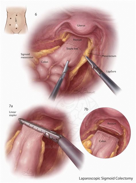 Laparoscopic Sigmoid Colectomy Alisa Brandts Portfolio