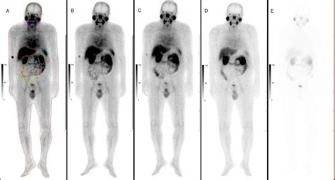 Mediso Radiation Dosimetry Of Tc 99m Psma Iands A Single Center