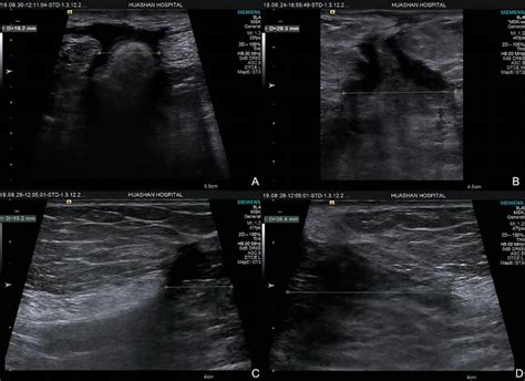 Hernia Width Of Two Groups Group A A Hernia Width 192 Mm B