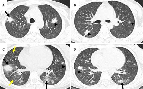 Pulmonary Invasive Fungal Disease And Bacterial Pneumonia A