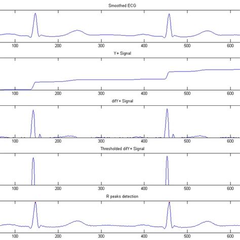 A Inverted T Wave B Biphasic T Wave Download Scientific Diagram