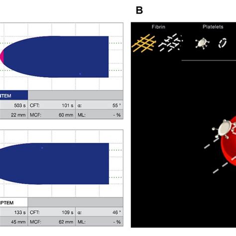 A A Conventional Rotem Result Showing A Heparin Effect B A Download Scientific Diagram