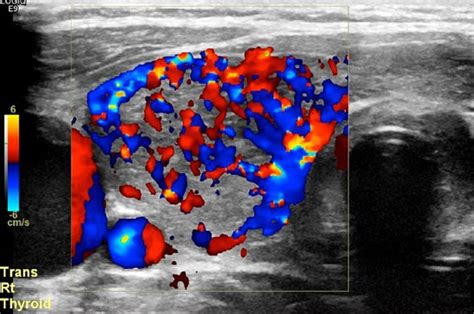 Thyroid Storm A Case From The Endocrine Teaching Clinics Mayo Clinic