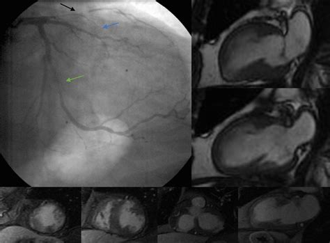 Patient A Upper Left Angiography Showing A Proximal Cto Lad Black