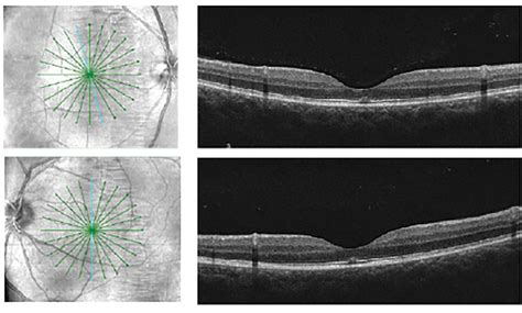 A Case Of Poppers Maculopathy