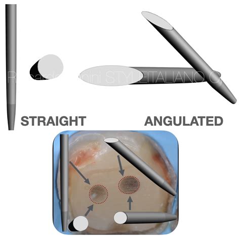 Fiber Post Removal Dont Miss The Post Style Italiano Endodontics
