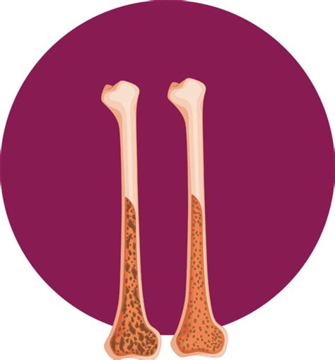 Bone Marrow Transplant In Chennai India Best Bone Marrow Transplant