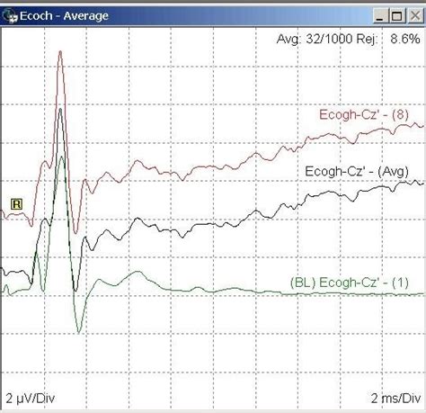 Electrocochleogram Ecoch With Cochlear Microphonics Cm Summation Download Scientific