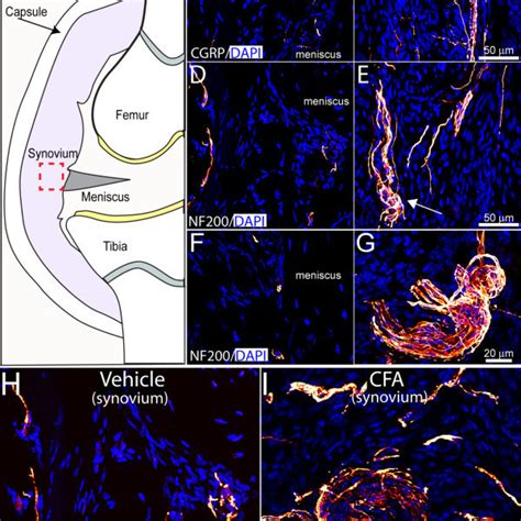 Sensory Nerve Fiber Sprouting And Formation Of Neuroma Like Structures