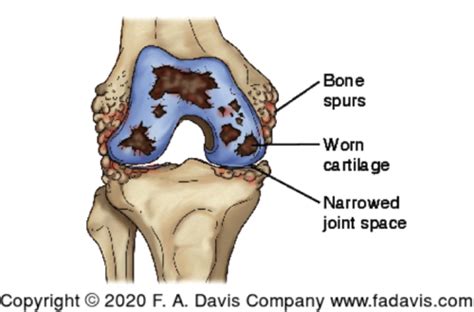 Pta 255 Knee Osteoarthritisaclpcl Injury Flashcards Quizlet