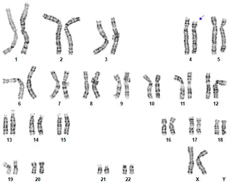 Chromosome Deletion