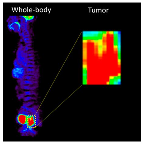 Cancers Free Full Text Prediction Of Neoadjuvant Chemoradiotherapy Response In Rectal Cancer