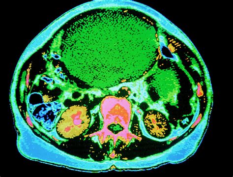 Coloured Ct Scan Of Ovarian Cancer By Science Photo Library