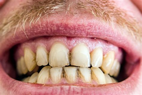 Is Getting Rid Of Black Triangles Between My Teeth Worth It