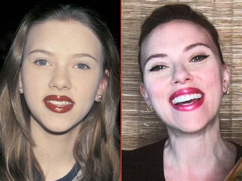Scarlett Johansson Before And After Plastic Surgery