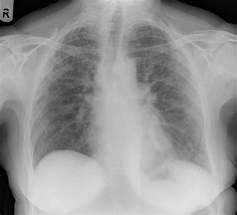 Pulmonary Fibrosis Xray