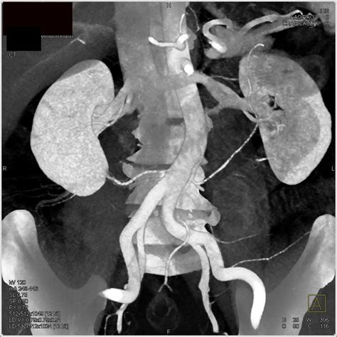 Circumaortic Left Renal Vein Vascular Radiology Case Studies Ctisus