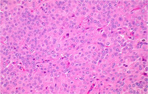 Observer Variation In The Diagnosis Of Testicular Sex Cord Stromal