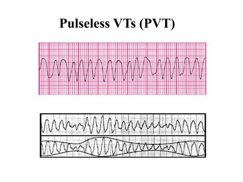 Advanced Cardiac Life Support Acls Shockable Non Shockable Rhythm Pptx