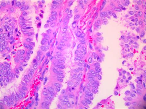 An Area Of Tall Cell Pattern Showing Parallel Long Papillae Formed By A