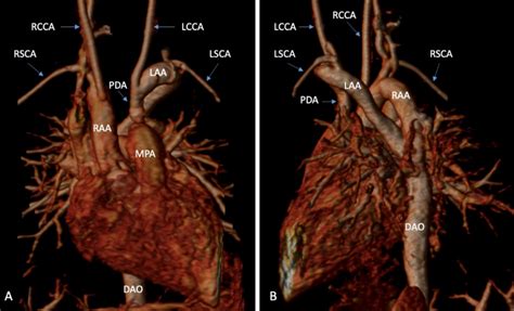 A Anterior View Of Magnetic Resonance Imaging Scan Showing Left Common