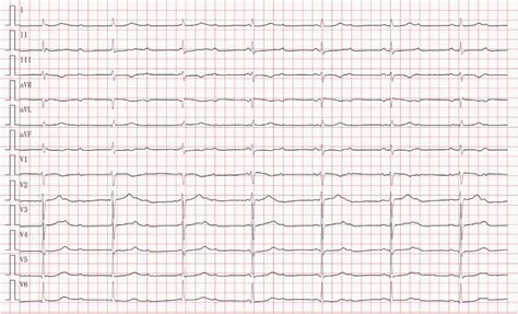Third‐degree Atrioventricular Block Download Scientific Diagram