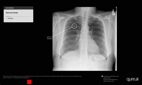 Time To Embrace X Ray Ai For Early Lung Cancer Detection The Imaging Wire