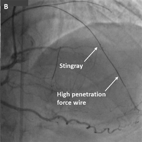 Example Of Using The Corssboss Stingray For A Lad Cto Case A