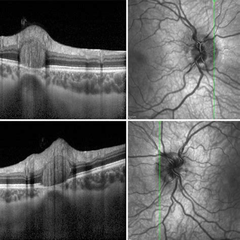 Four Pediatric Patients With A Known Diagnosis Of Tilted Disc Syndrome