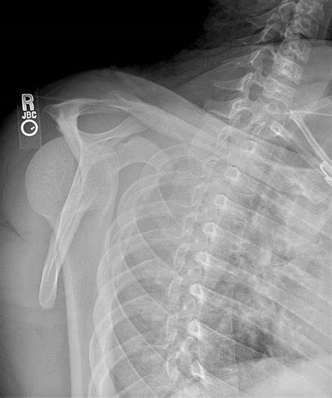 Posterior Shoulder Dislocation Resus