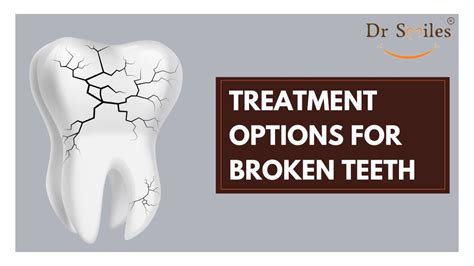 Treatment Options For Broken Teeth From Bonding To Crowns