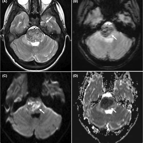 Mri Work‐up At Admission Two Axial Transverse Slices In Similar Slice