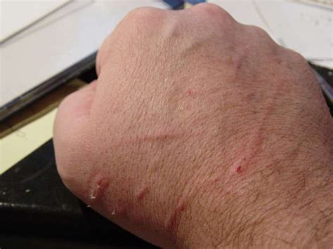 How To Tell If You Have Cat Scratch Fever At Milla Slessor Blog