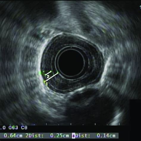 High Resolution Esophageal Manometry Of A Hiatal Hernia Through A