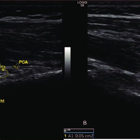 Axillary Nerve Block In Quadrangular Space Under The Guidance Of Download Scientific Diagram