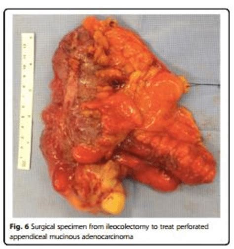 Surgical Specimen From A Ileocolectomy To Treat Perforated Download Scientific Diagram
