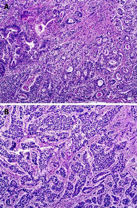 Cholangiocarcinoma Histology
