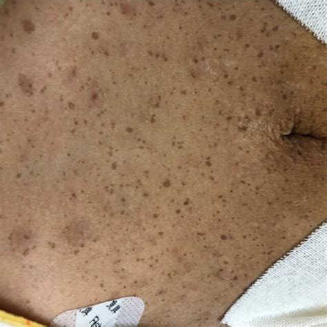 Clinical Presentation Of Multiple Diffuse Skin Neurofibromas And Axial Download Scientific