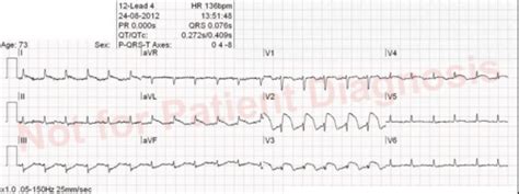 ECG Flashcards Quizlet