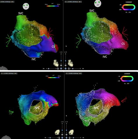 Activation Mapping With Integration Of Vector And Velocity Information
