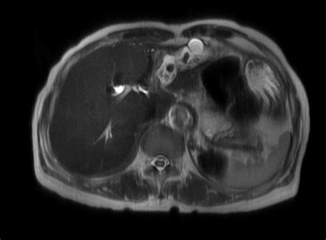 Recurrent Pyogenic Cholangitis Wikidoc