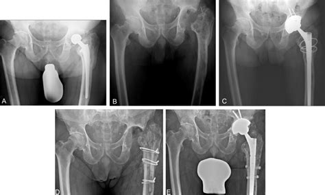 66 Year Old Male Patient With Chronic Periprosthetic Joint Infection Download Scientific