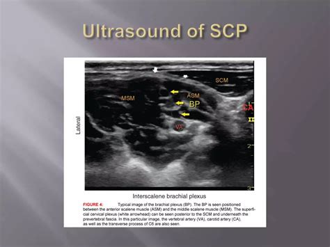 25820 Cervical Plexus Block 1 Pptx