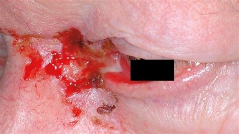 Nodular And Infiltrative Bcc On Eye Erivedge® Vismodegib