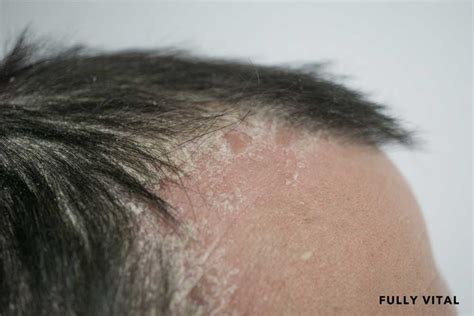 Understanding Scalp Psoriasis A Comprehensive Guide For Hair Growth